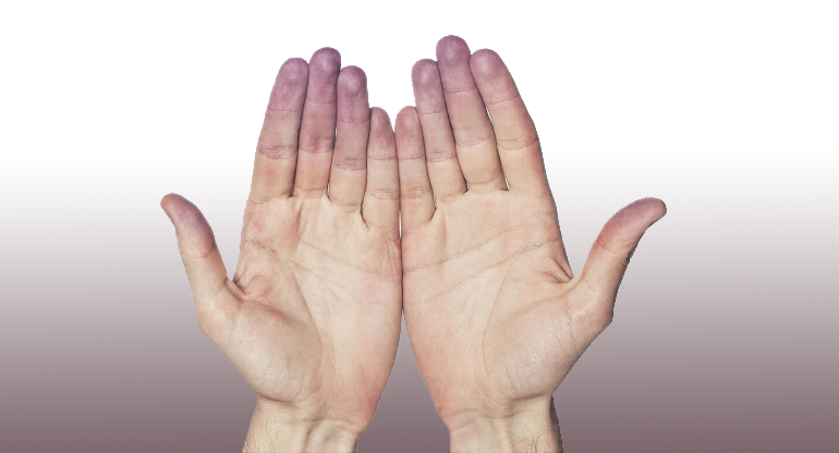 Entenda o Fenômeno de Raynaud – amplamedicina.com.br